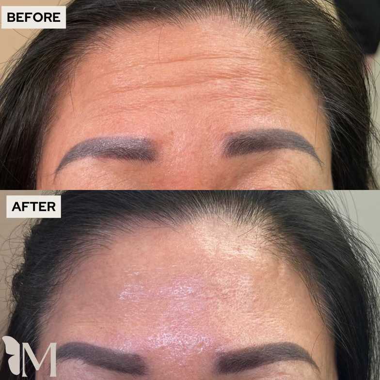 Neurotoxin (Botox + Dysport) | Injectables | Morphia Beauty Clinic